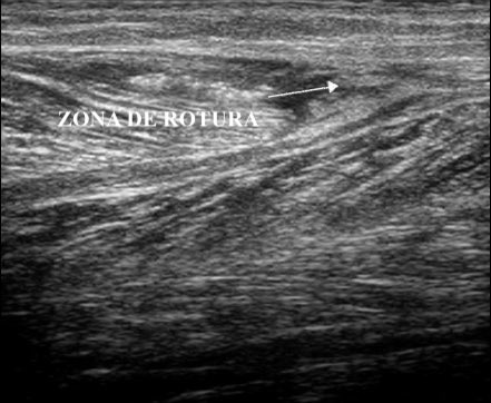 Lesión muscular de gemelo - Doctor Pablo Carnero - Traumatólogo